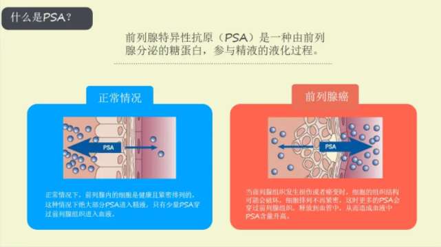 男性前列腺特异性抗原PSA升高，不用紧张（一）_【快资讯】